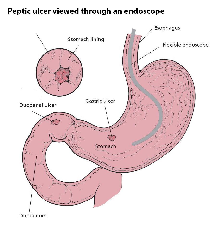 Peptic ulcer - Harvard Health Peptic ulcer - Harvard Health